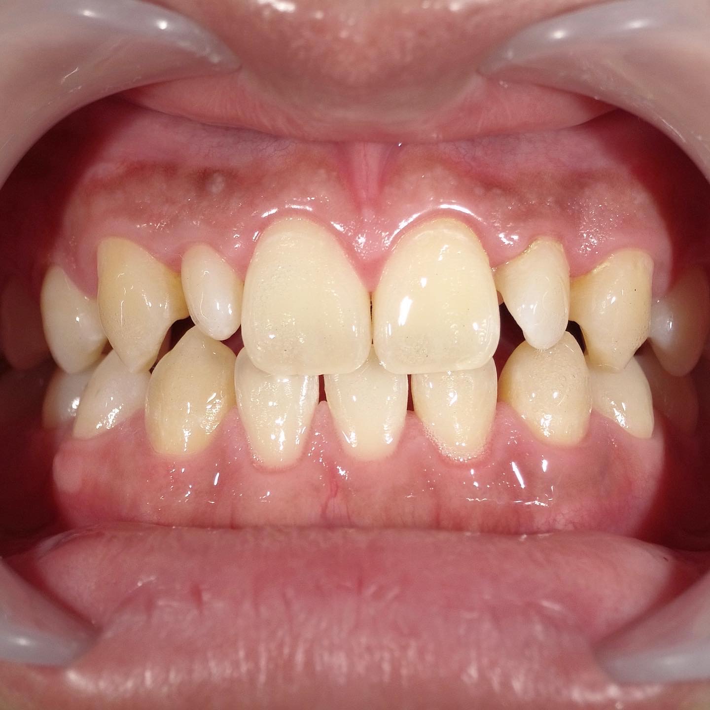 ポリリン酸ホワイトニング￥6600【税込】 - 大阪市西区の歯医者なら、新町プラザ歯科